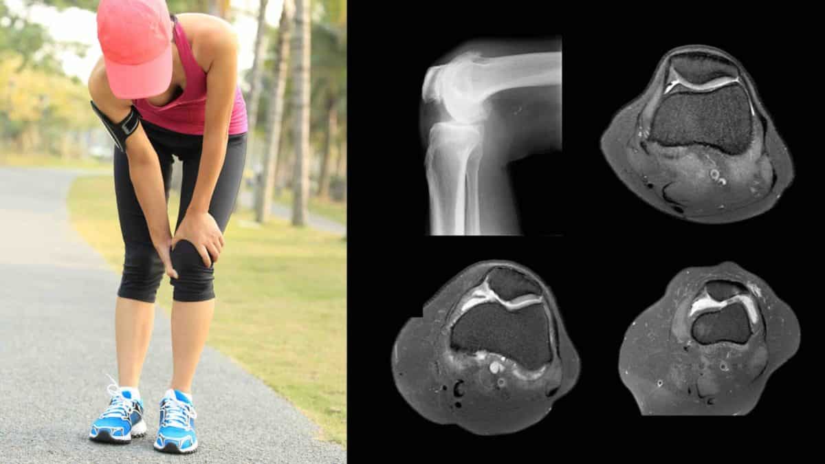 Anatomia do Joelho - Clínica do Joelho