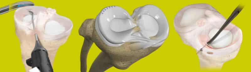 Sutura de menisco - Clínica do Joelho