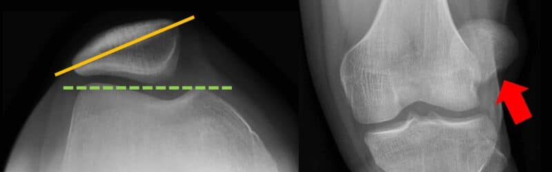 Realinhamento patelar - Clínica do Joelho