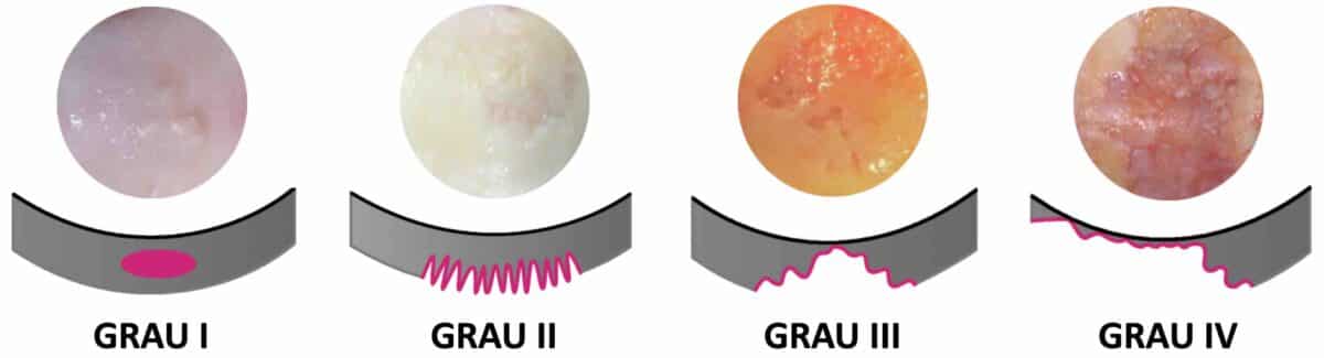Condromalácia Patelar - Clínica do Joelho