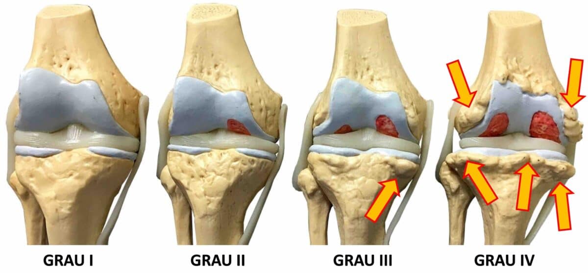 Osteófitos no Joelho - Clínica do Joelho