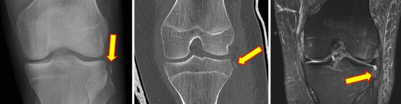 Fratura de Segond - Clínica do Joelho