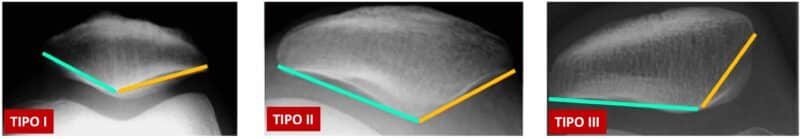 Patela - Clínica do Joelho