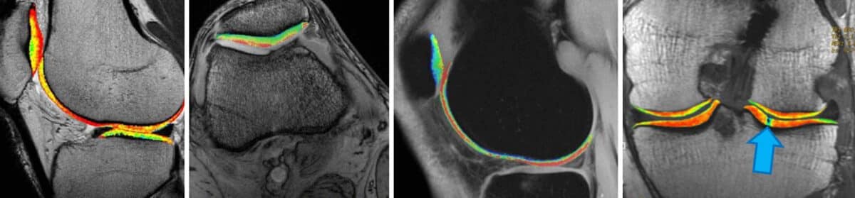 Condropatia - Clínica do Joelho