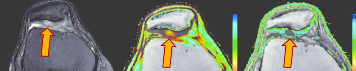 Condropatia - Clínica do Joelho