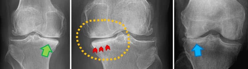 Esclerose subcondral no Joelho - Clínica do Joelho