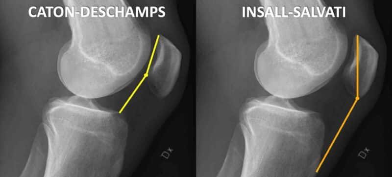 Patela alta - Clínica do Joelho