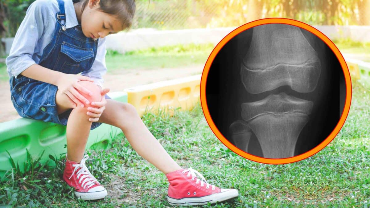 Sinovite transitória do Joelho - Clínica do Joelho