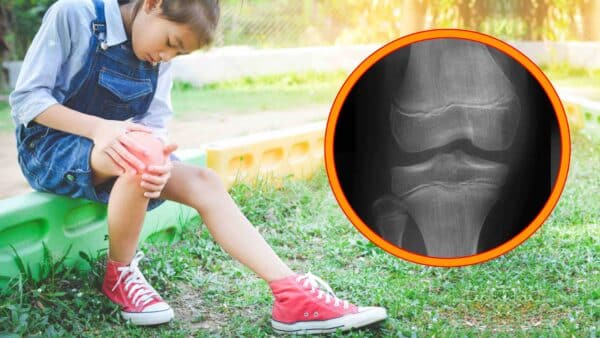 Sinovite transitória do Joelho - Clínica do Joelho