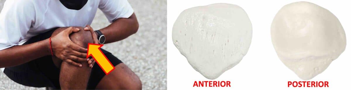 Patela - Clínica do Joelho