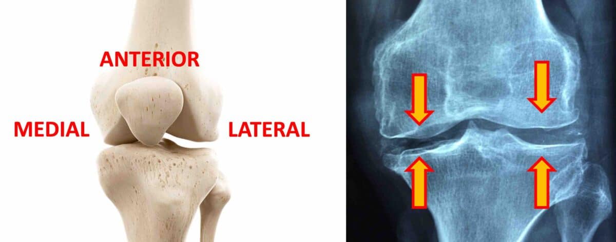 Artrose tricompartimental - Clínica do Joelho