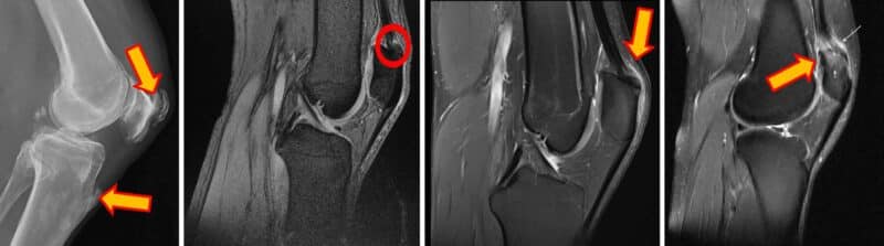Entesopatia - Clínica do Joelho