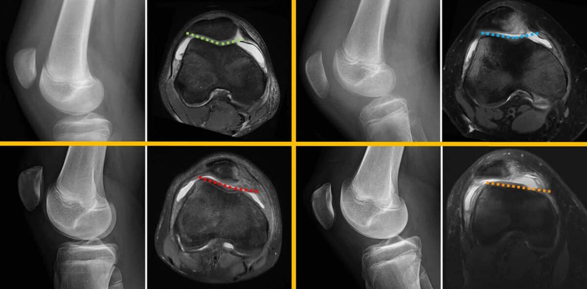 Displasia da tróclea - Clínica do Joelho