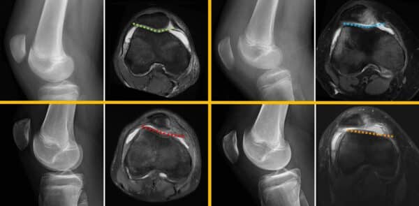 Displasia da tróclea - Clínica do Joelho