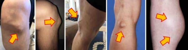 Caroço no Joelho - Clínica do Joelho