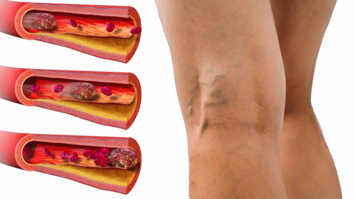 Trombose no Joelho - Clínica do Joelho