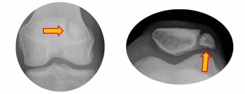 Patela bipartida e Dor no Joelho - Clínica do Joelho