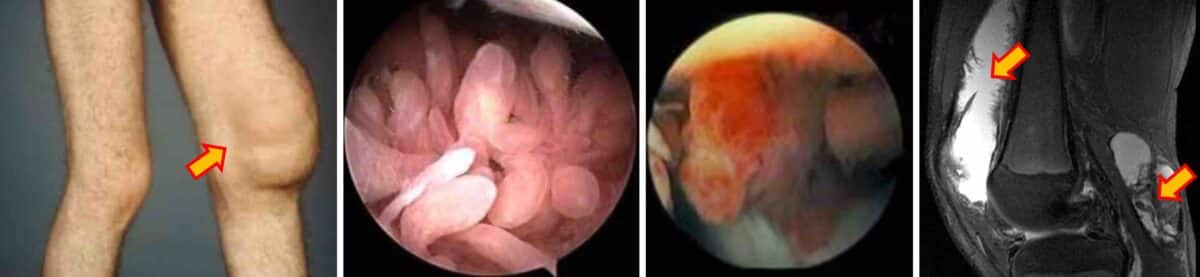 Membrana sinovial - Clínica do Joelho