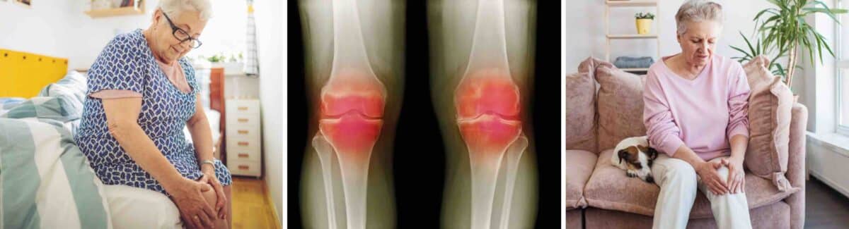 Artrite reumatóide e Artrose do Joelho - Clínica do Joelho