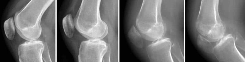 Patela baixa - Clínica do Joelho