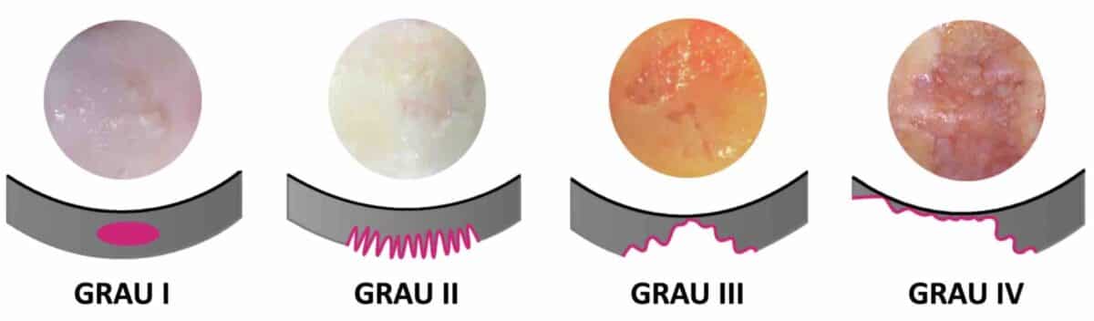 Lesão condral - Clínica do Joelho