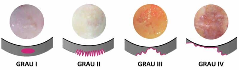 Lesão condral - Clínica do Joelho