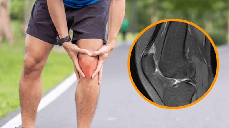 Gordura suprapatelar - Clínica do Joelho