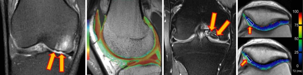 Lesão condral - Clínica do Joelho