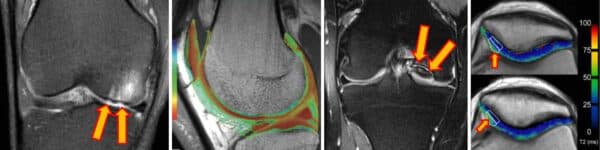 Lesão condral - Clínica do Joelho