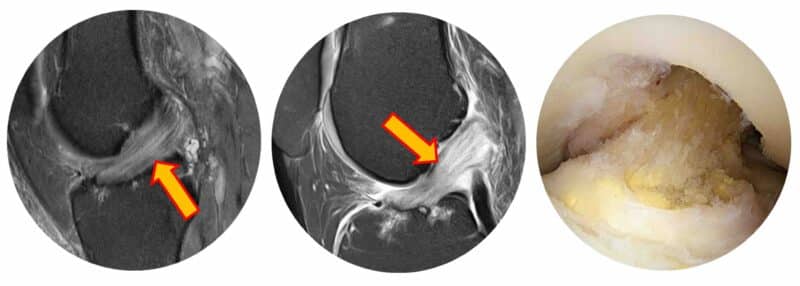 Degeneração mucóide do ligamento cruzado anterior - Clínica do Joelho
