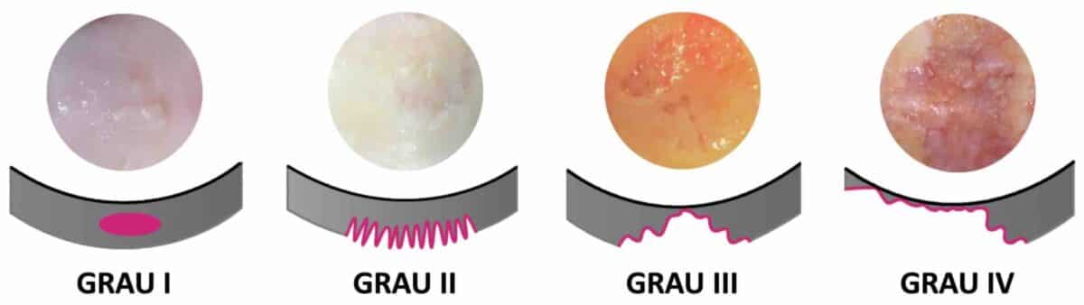 Condropatia patelar e condropatia troclear - Clínica do Joelho