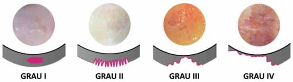 Condropatia patelar e condropatia troclear - Clínica do Joelho