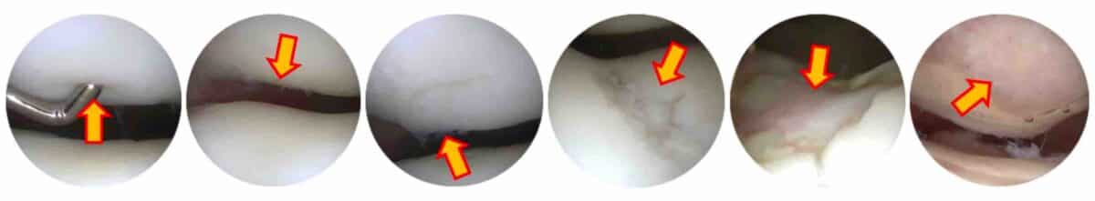 Condropatia patelar e condropatia troclear - Clínica do Joelho